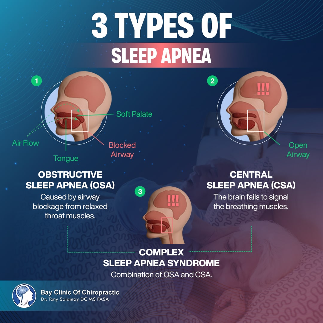 Sleep Apnea: Types, Symptoms, Causes, and Natural Remedies