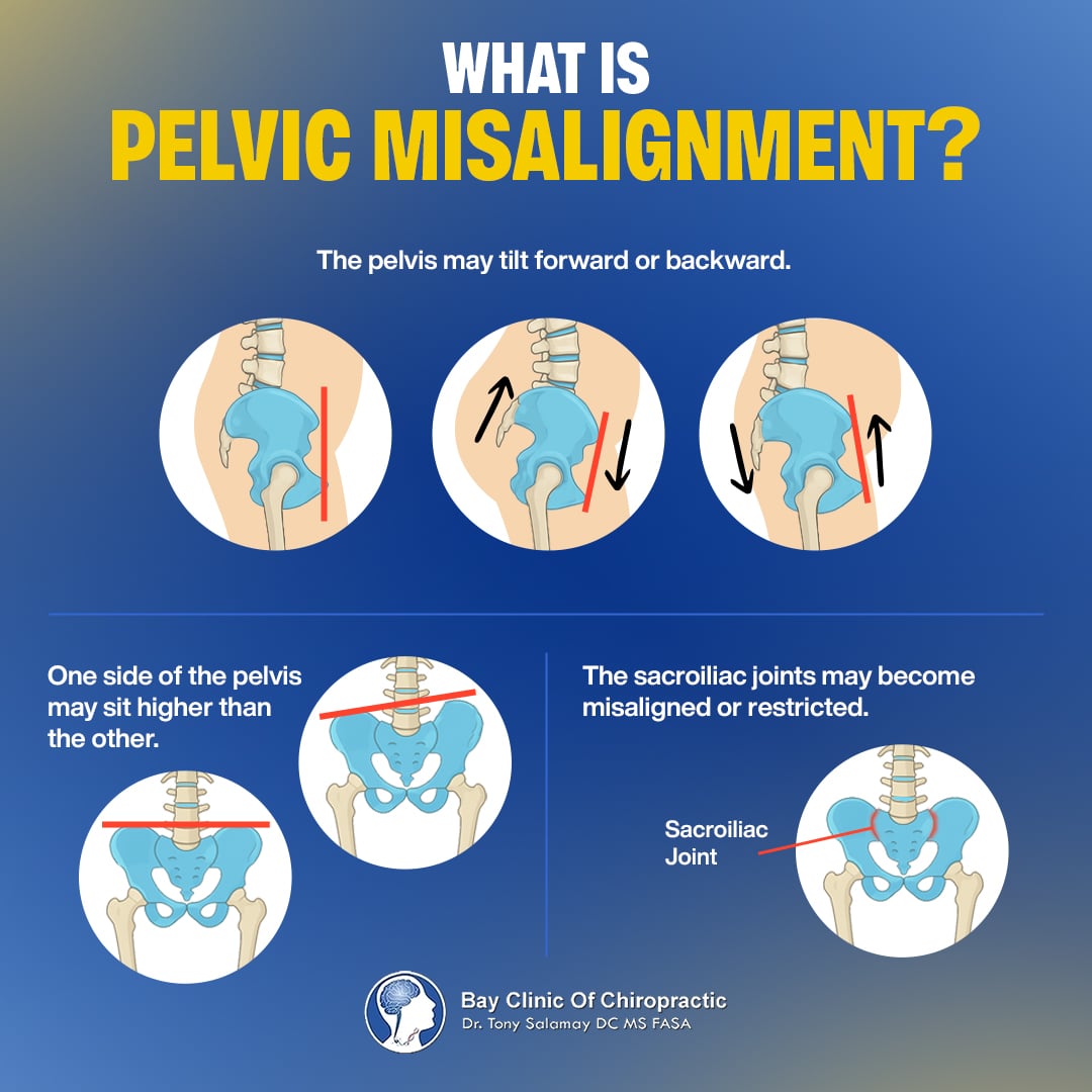 Pelvic Misalignment: Signs, Causes & Natural Treatment Options
