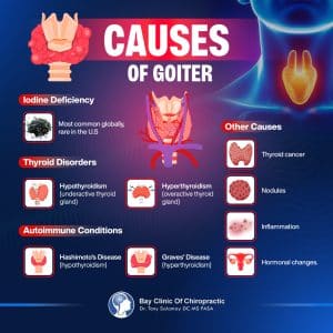 Goiter: Symptoms, Causes and Natural Treatment