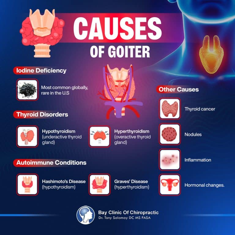 Goiter: Symptoms, Causes and Natural Treatment