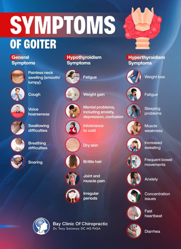 Goiter: Symptoms, Causes and Natural Treatment