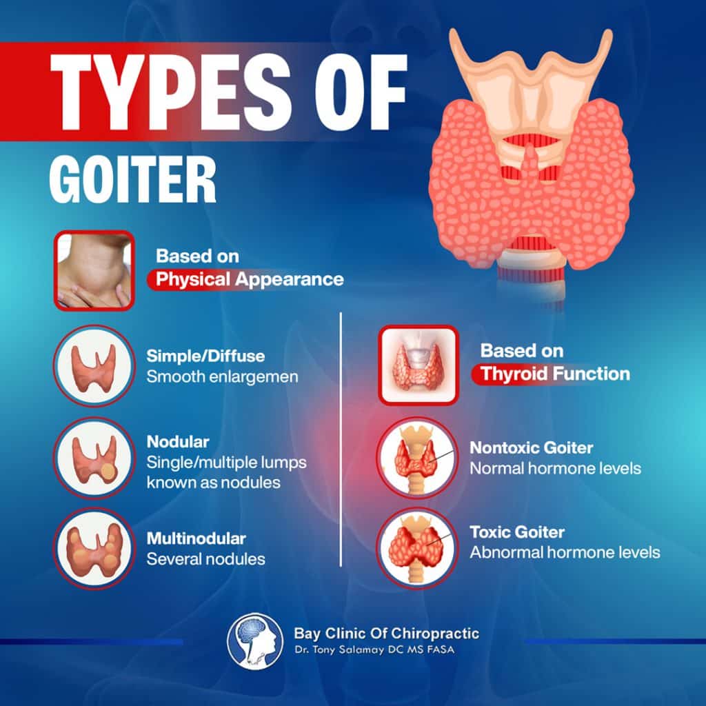 Goiter: Symptoms, Causes and Natural Treatment