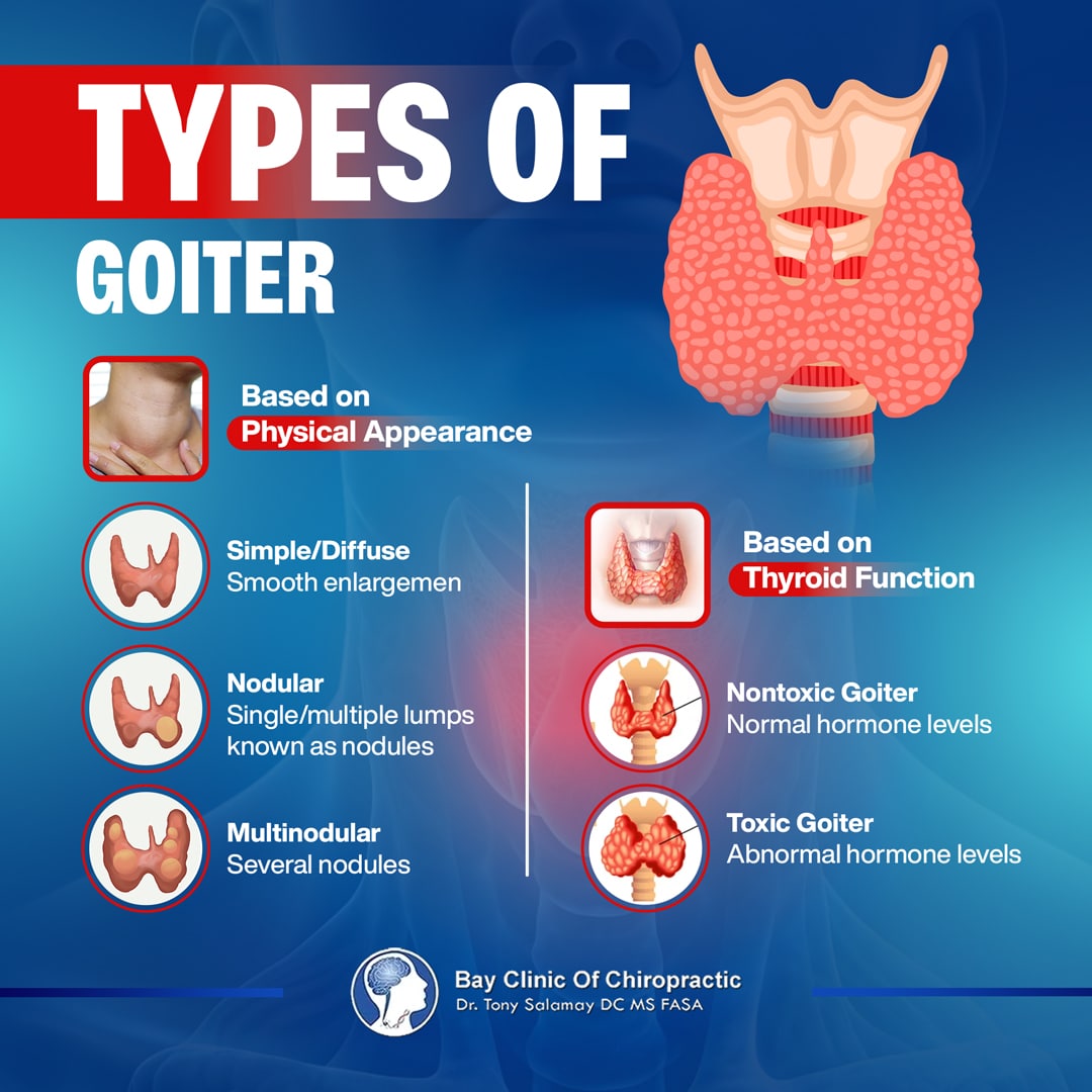 Goiter: Symptoms, Causes and Natural Treatment